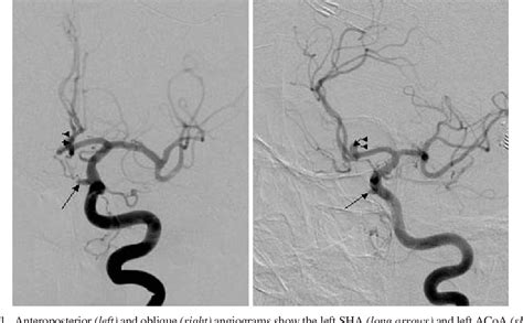 Structure Of Superior Hypophyseal Artery Semantic Scholar