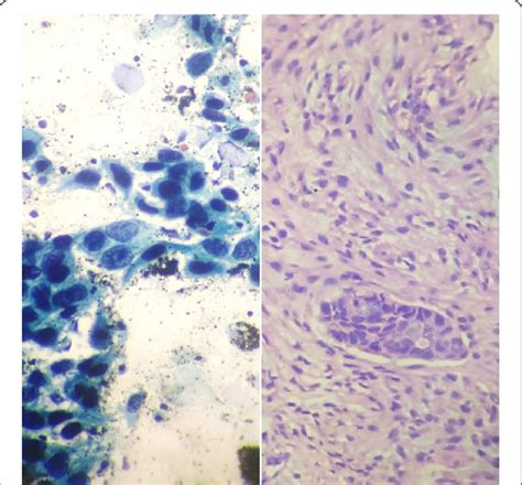 Squamous Cell Carcinoma Lung Mgg Stained Squash Smear Cytology And