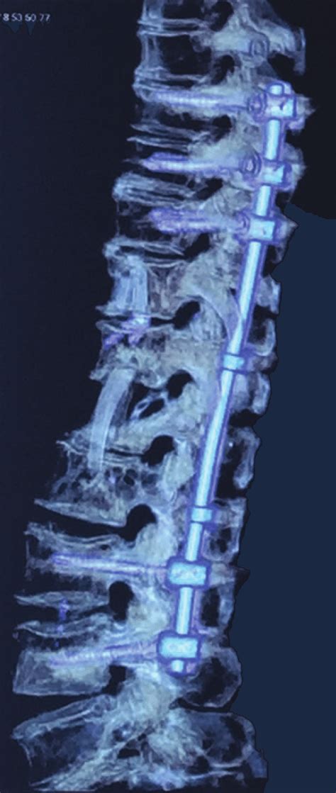 Postoperative 3d Ct Images After Anterior Debridement L1 Corpectomy
