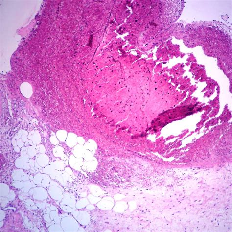 Human Chronic Peptic Ulcer Sec 7 µm Hande Microscope Slide Carolina