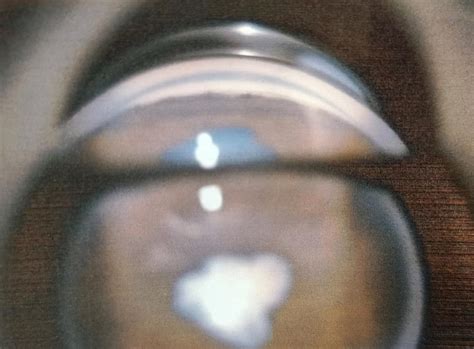 Eye Surgery Case Bhopal 40 Yr Lady With Chronic Uveitis Complicated