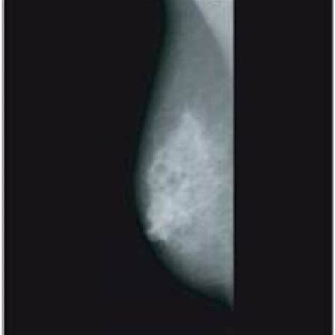 A Nonnal Mammogram B After Noise Filtering C After Enhancement