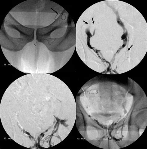 A After The Vein Was Punctured With A 20‑gauge Needle A 0 018