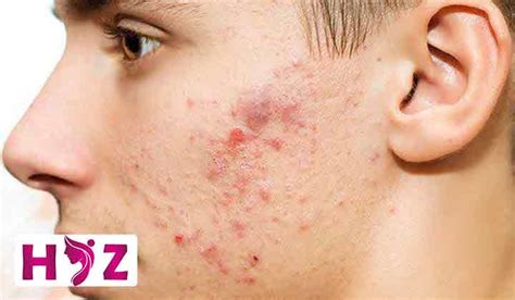 درمان قطعی جوش صورت درمان جوش های چرکی دردناک های زیبا