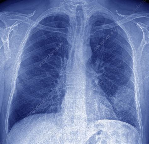 Segmental Pneumonia Lung X Ray Stock Image C038 4562 Science