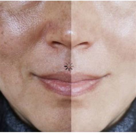 Melasma And Hyperpigmentation Laser Treatment Melbourne