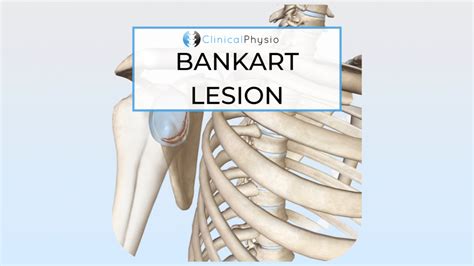 Bankart Lesion