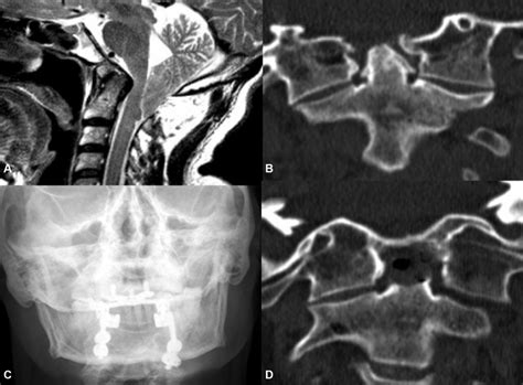 A Preoperative Sagittal T2 Mri Showing The Basilar Invagination Download Scientific Diagram