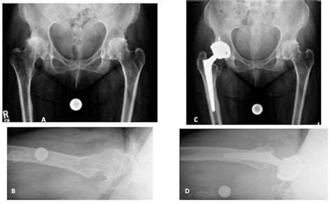 Rheumatoid Arthritis X Ray Hip