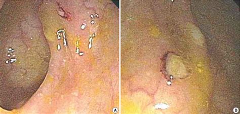 Figure 1 From Mycophenolate Mofetil Related Colitis A Case Report Corresponding Semantic Scholar