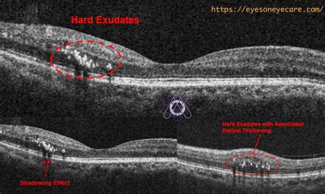 OCT Hard Exudates Highly Reflective Lesions In The Eye