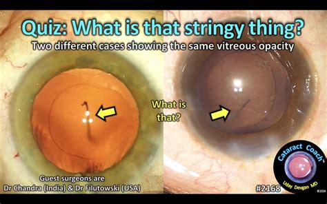 2168 Quiz Persistent Hyaloid Artery Cataract Coach™