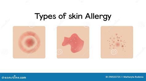 Types Of Skin Allergy Vector Illustration Design Stock Illustration Illustration Of