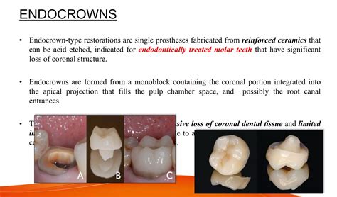 Rehabilitation Of Endodontically Treated Teeth Post And Core Pptx