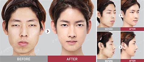 Nano Bimaxillary Osteotomy At View Plastic Surgery Korea Medical Hub