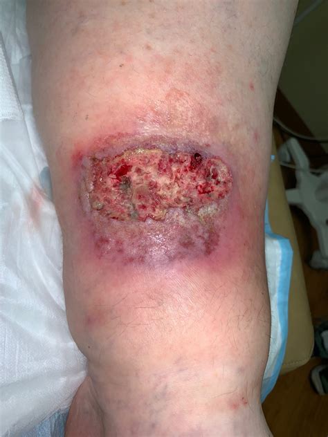At Last Hope For Patients With Pyoderma Gangrenosum Share This