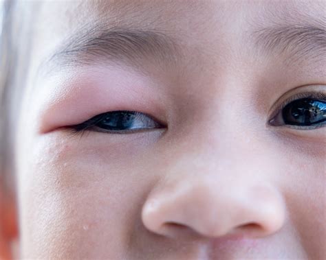 Stye Overview Symptoms Causes Optimists Wellness Health Fitness
