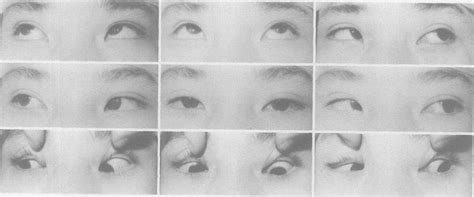 一、重症肌无力 斜视诊疗