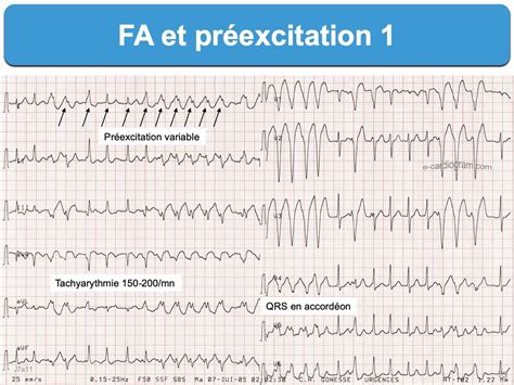 Super Wolff E Cardiogram