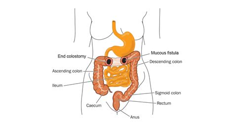 Mucous Fistula Surgery For Ibd Ibdrelief