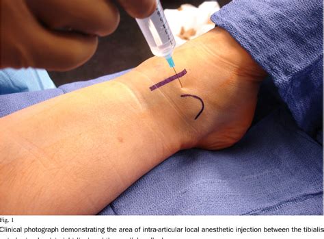 Figure 1 From Intra Articular Block Compared With Conscious Sedation For Closed Reduction Of