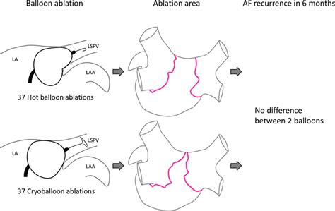 Hot Balloon Versus Cryoballoon Ablation For Atrial Fibrillation Circulation Arrhythmia And