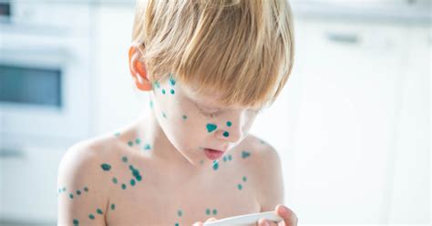 ჩუტყვავილას აფეთქება როცა ვერც ვაქცინას პოულობ და ვერც პასუხს ჯანდაცვის უწყებებისგან