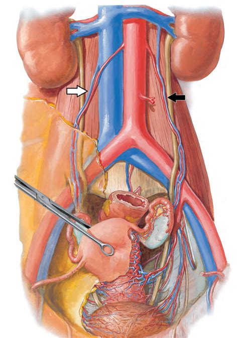 Illustration Demonstrates Ovarian Veins Arising From The Ovarian Venous