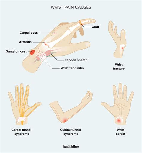 Wrist Pain Causes Symptoms And Treatments