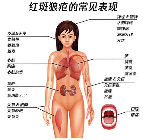 “红斑狼疮”你了解多少？来源系统性器官