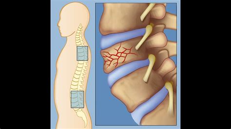 Types Of Spinal Fractures Radiology Design Talk