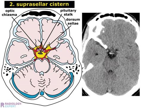 Ct Brain Hemorrhage