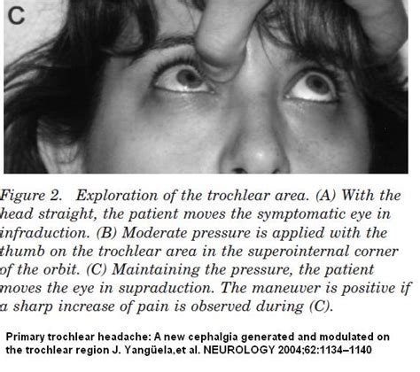Quick Fix For Headaches Repeated Nerve Supraorbital Infraorbital And Occipital Nerve Blocks
