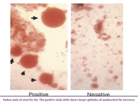 Malabsorption Syndromepptx