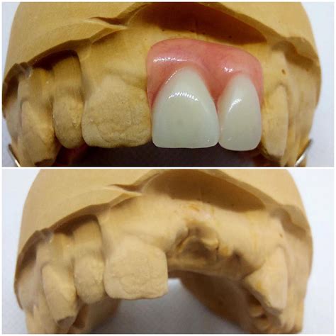 Dental Flipper Dentures Dental Flipper Meaning Dtwnir