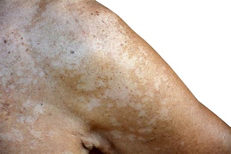 Tinea Versicolor Skinterrupt