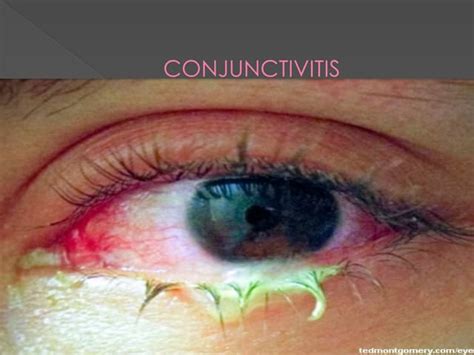 Conjunctivitis Pptx Ppt