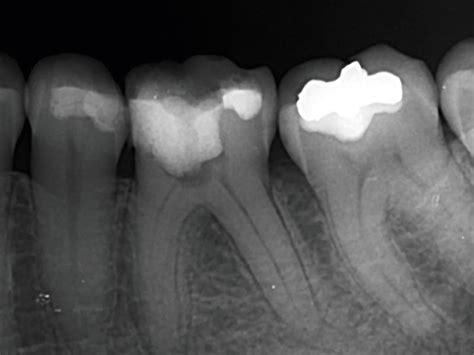 Шүдний мэдрэл тасдах сувгийн эмчилгээ гэж юу вэ Индранил Дентал Менежмент ХХК