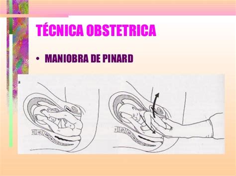 Distocias De Contracción
