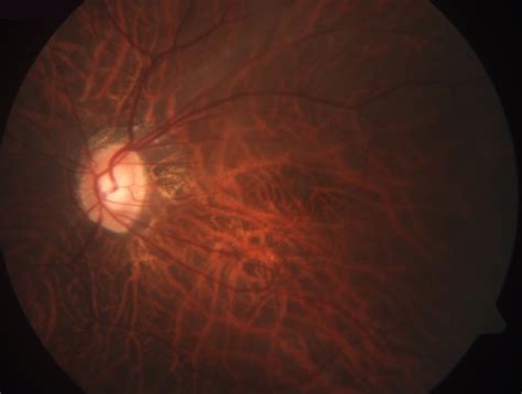 Myopic Choroidal Neovascularization Retina Image Bank