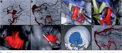 [pdf] Cranio Orbito Zygomatic Approach Semantic Scholar