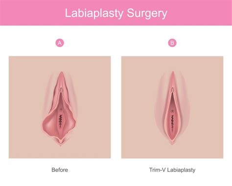 What Do Normal Vaginas Look Like Salameh Plastic Surgery Center