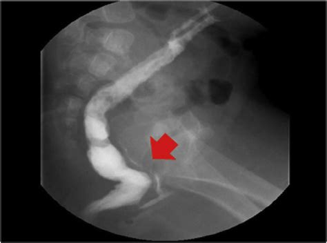 Distal cologram. Complex rectovaginal fistula. | Download Scientific ...
