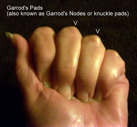 Garrods Pads Are Sometimes Seen In Those Who Have Dupuytrens Contracture Often The Garrods