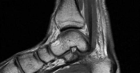 Ruptured Achilles Tendon Mri Imgur