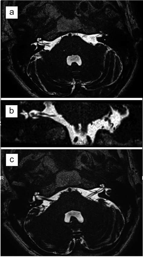 A Magnetic Resonance Image Of A Right Sided Type 3a Vascular Loop B