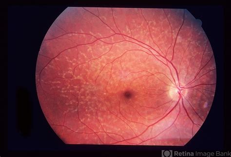 Reticular Pattern Dystrophy Retina Image Bank