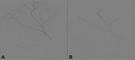 Lateral Angiograms Of The Mma Before Embolization A And After Download Scientific Diagram