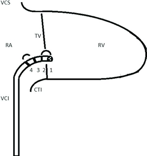 This Schematic Illustrates Why The Conventional Ablation Electrodes Download Scientific Diagram
