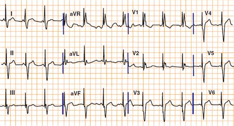 Ecg Localization Of Ventricular Pacing Ecg